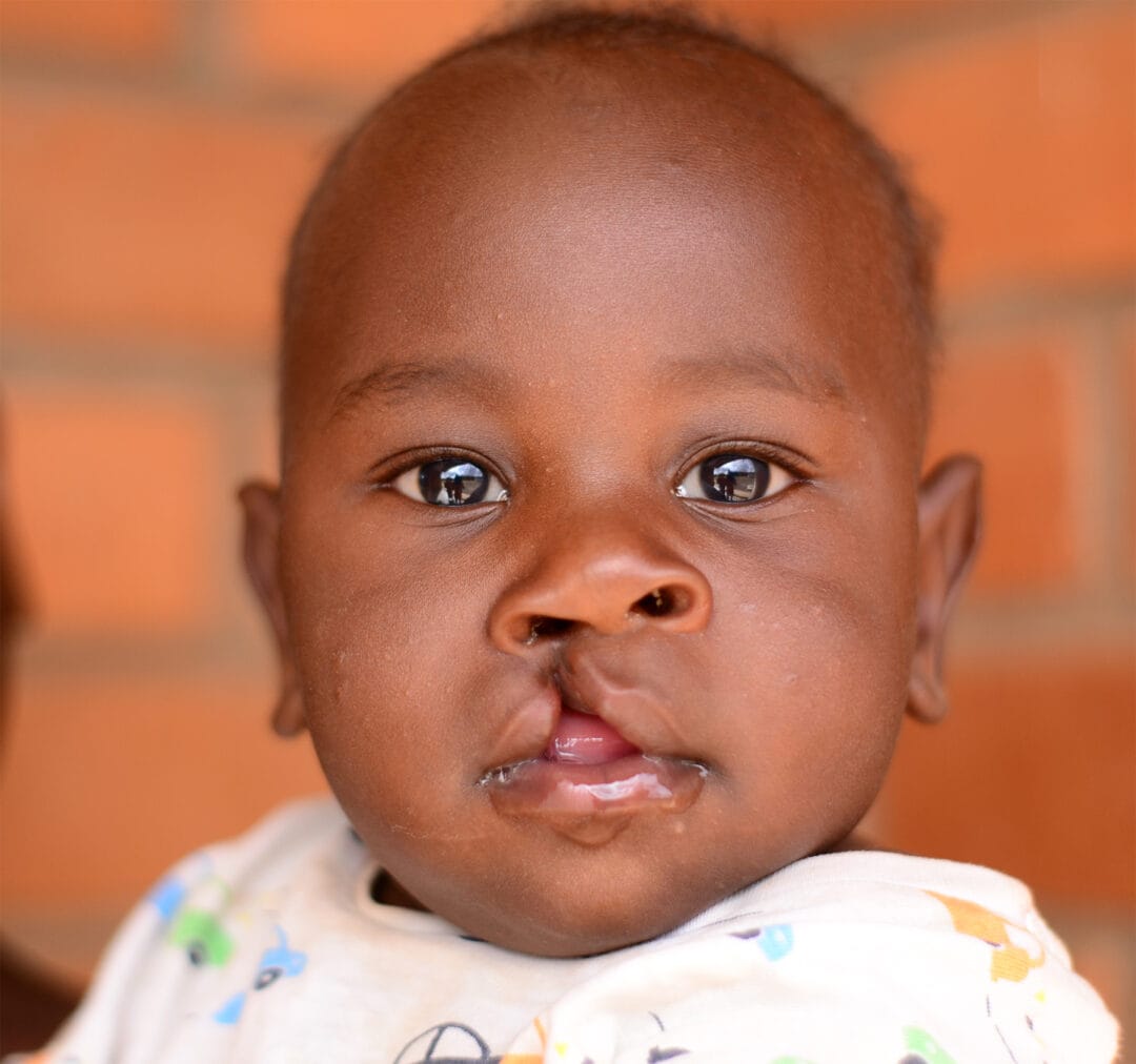 Operation Smile Malawi - Cleft Lip & Palate Children's Charity ...
