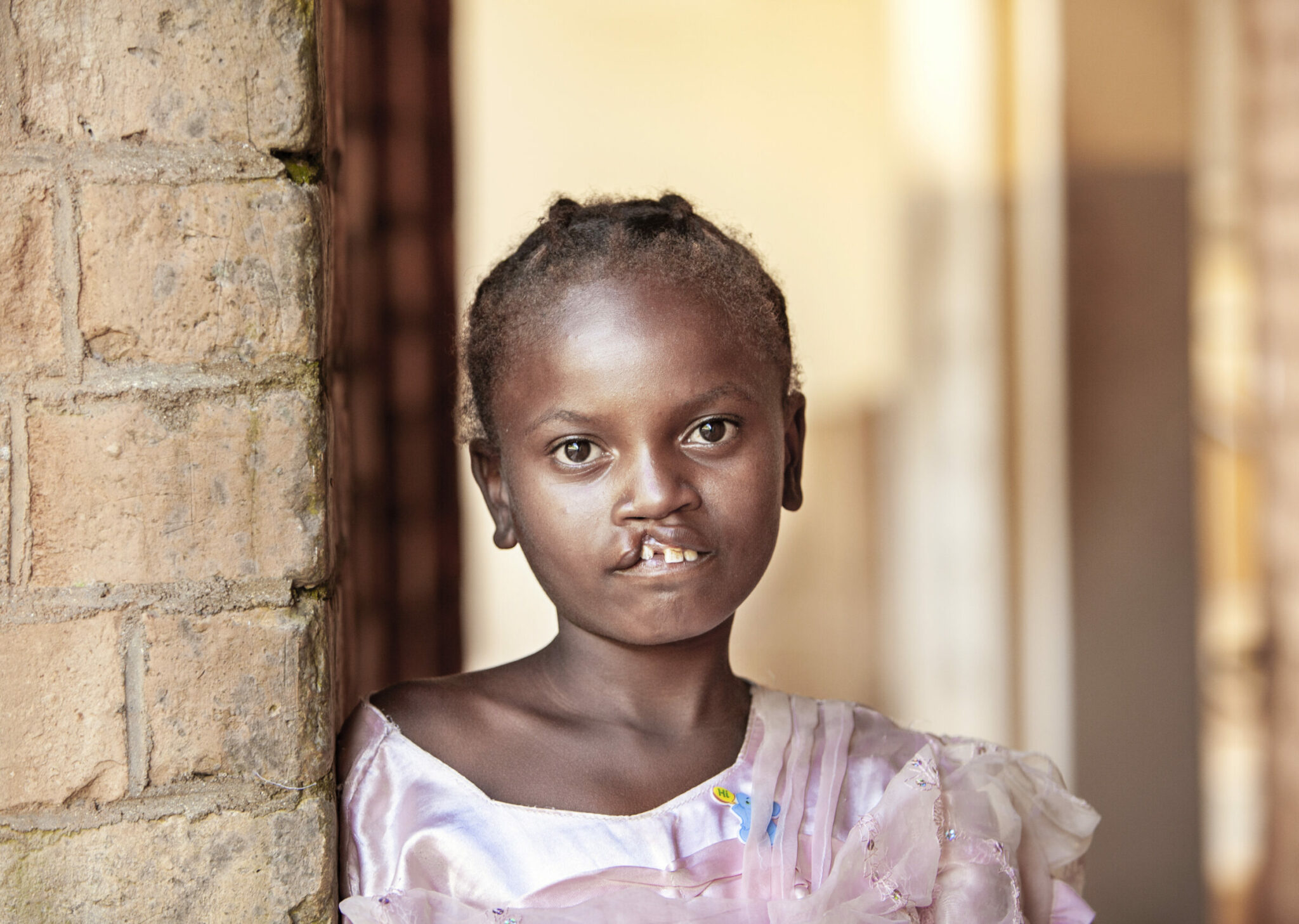 Sandra's Story - Cleft Lip & Palate Children's Charity | Operation ...