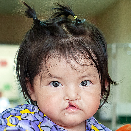 Annika's story - Cleft Lip & Palate Children's Charity | Operation ...