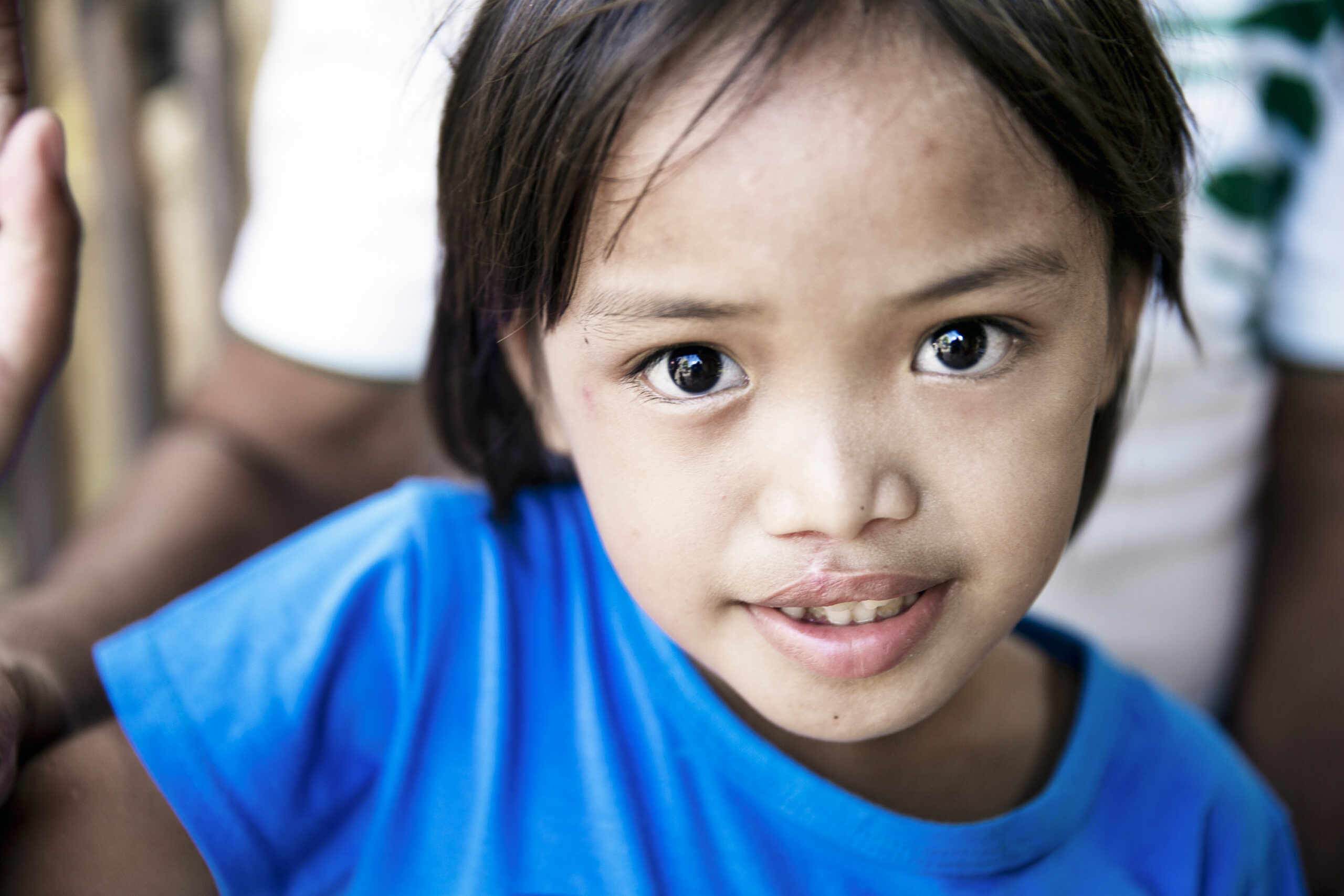 Jane Rose's Story - Cleft Lip & Palate Children's Charity | Operation ...