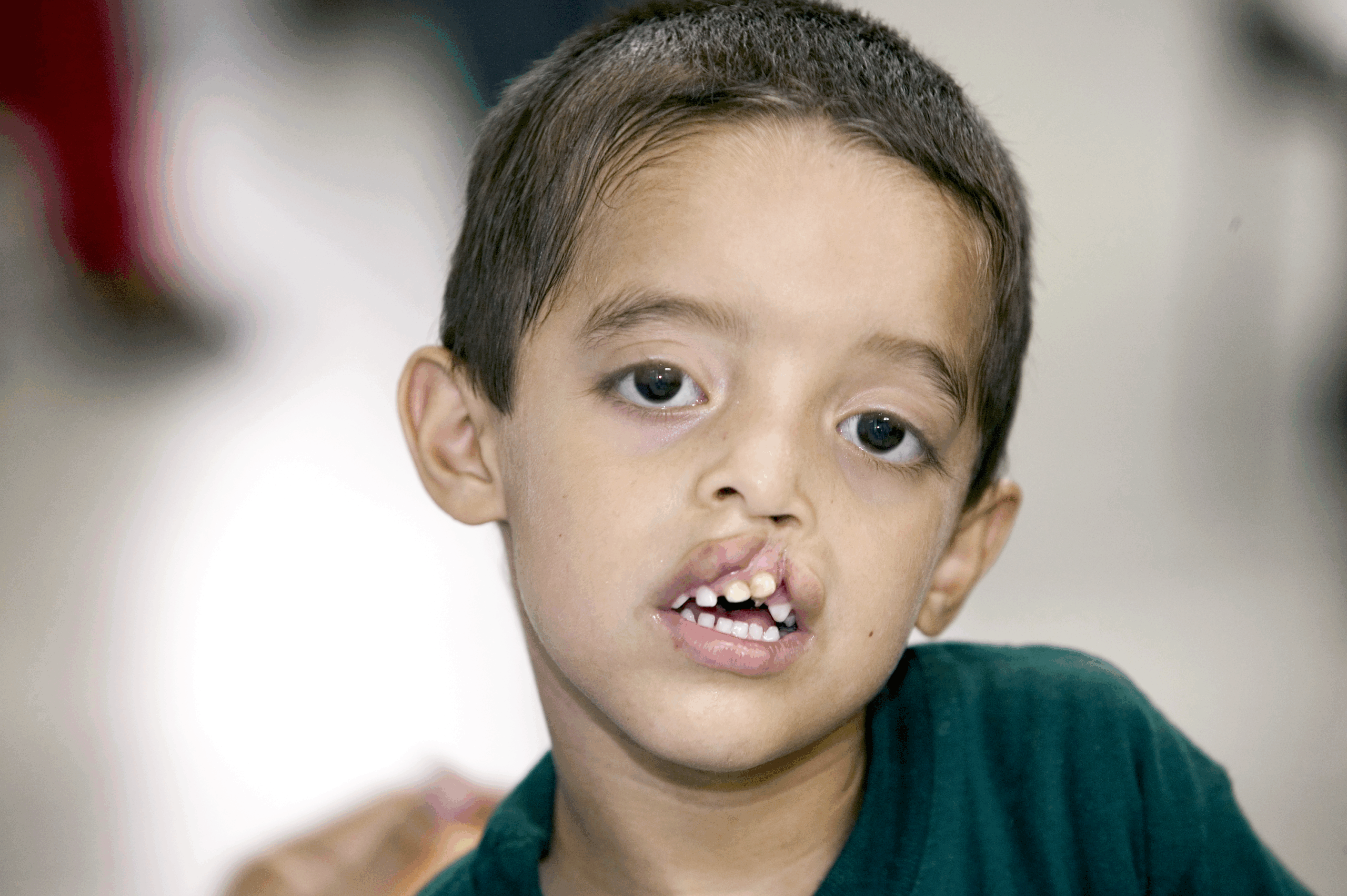 Arnoldo's story - Cleft Lip & Palate Children's Charity | Operation ...